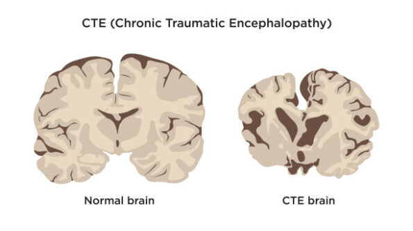 Chronic Traumatic Encephalopathy: Is CTE A Disability?